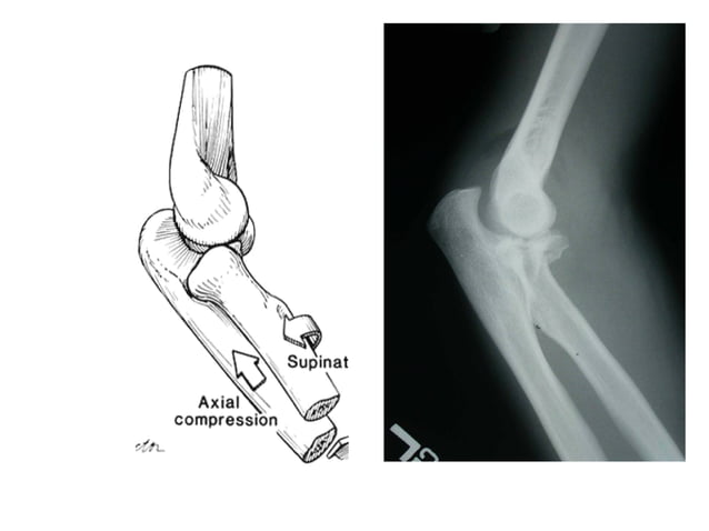 Σύνθετα Κατάγματα του Αγκώνα- Complex fractures of the elbow | PPT