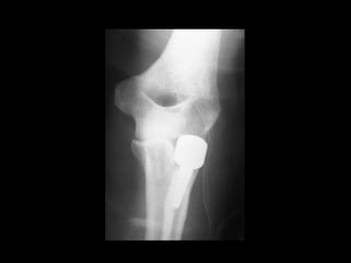 Σύνθετα Κατάγματα του Αγκώνα- Complex fractures of the elbow | PPT