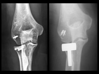 Σύνθετα Κατάγματα του Αγκώνα- Complex fractures of the elbow | PPT