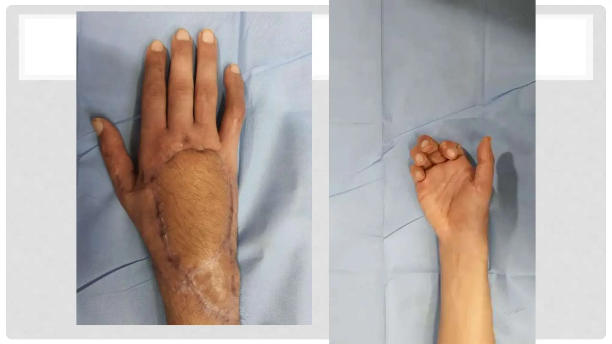 complex hand trauma diagnosis and management .pptx