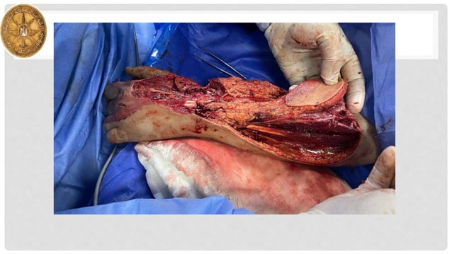 complex hand trauma diagnosis and management .pptx