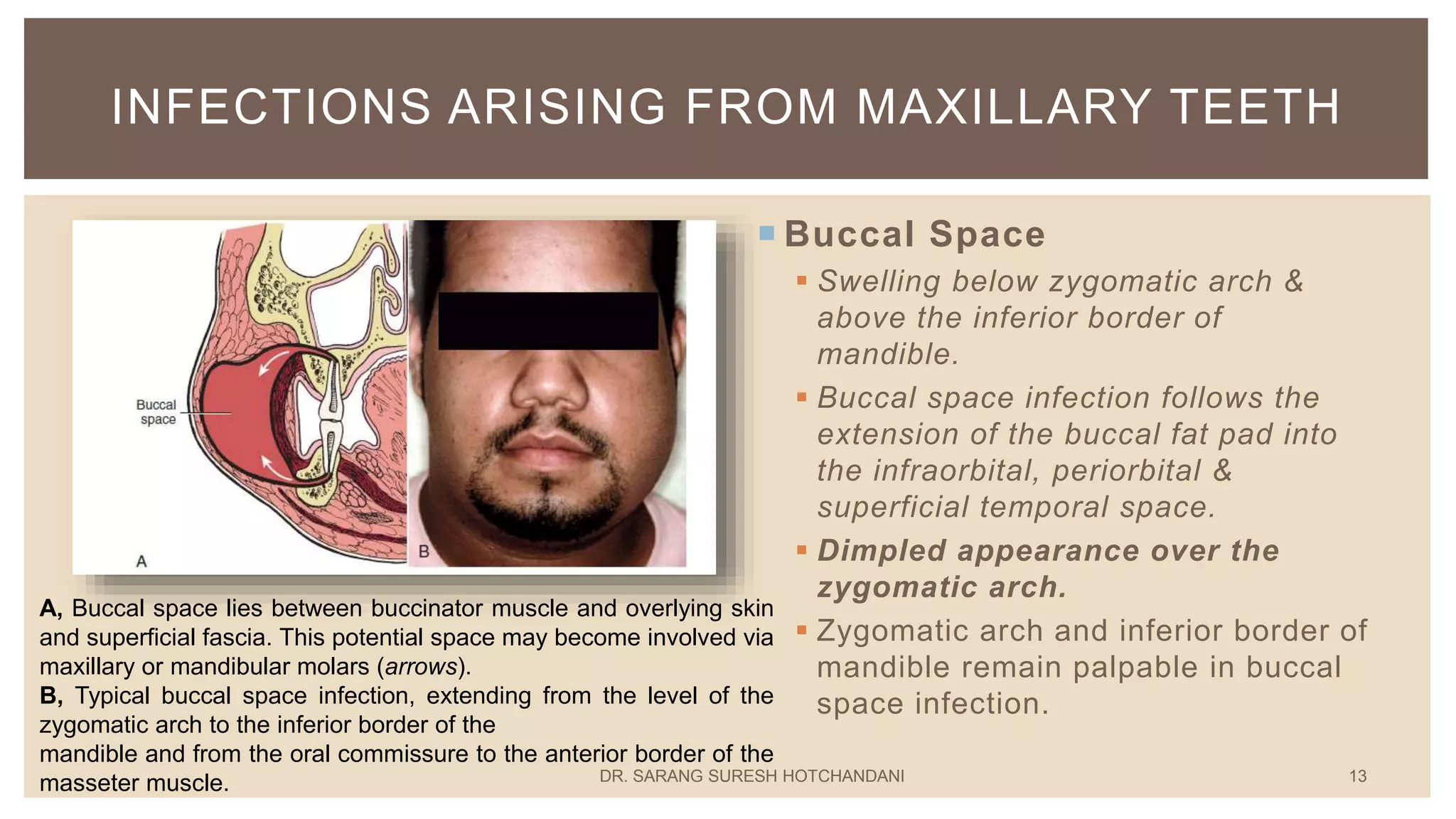 Complex Odontogenic Infection (Oral & Maxillofacial Surgery - Dentistry ...