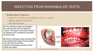 Complex Odontogenic Infection (Oral & Maxillofacial Surgery - Dentistry ...