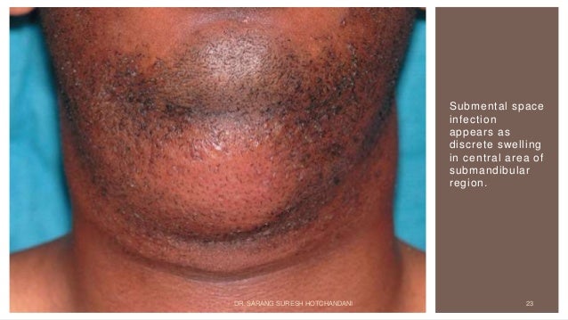 Complex Odontogenic Infection (Oral & Maxillofacial Surgery - Dentist…