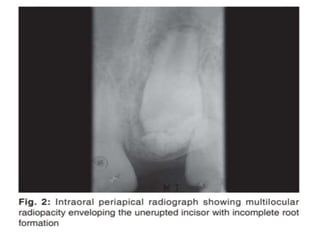 Complex odontome associated with maxillary impacted | PPTX