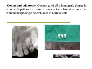 Complex odontome associated with maxillary impacted | PPTX