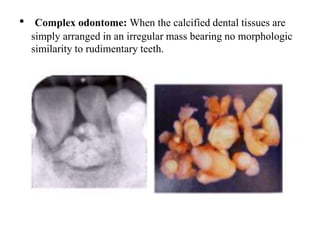Complex odontome associated with maxillary impacted | PPTX