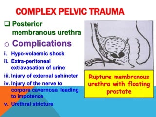 Complex pelvic trauma 1 | PPTX