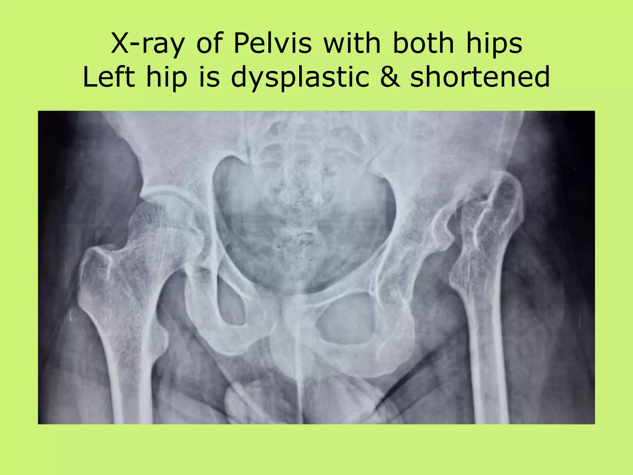 Complex primary hip replacement Dr.A.K.Venkatachalam | PPTX