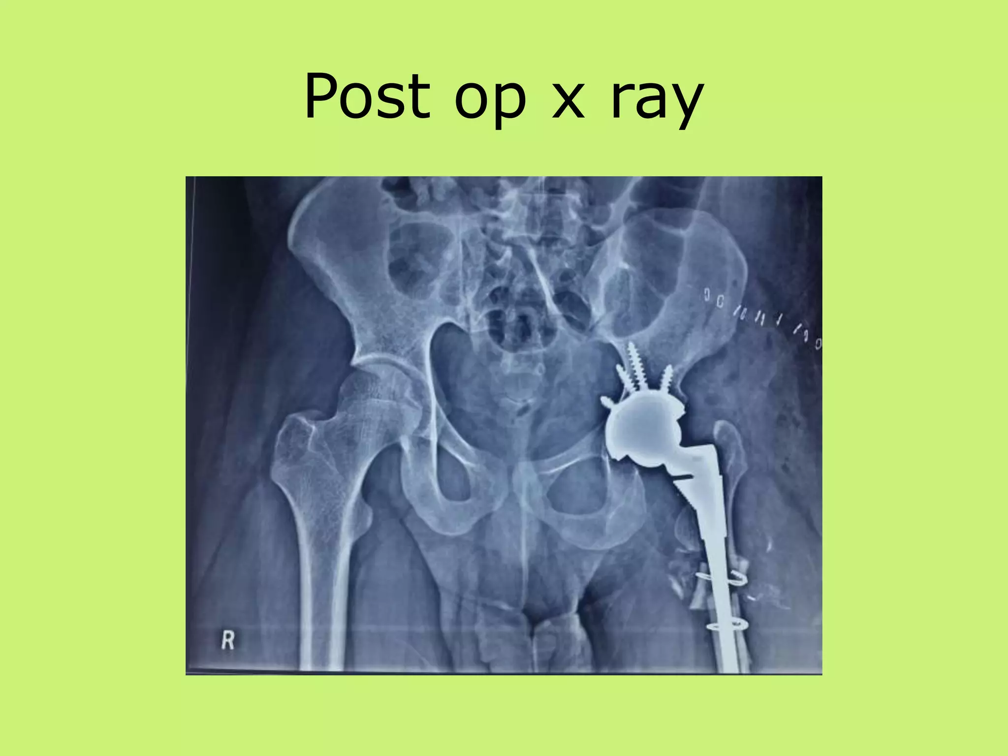 Complex primary hip replacement Dr.A.K.Venkatachalam | PPTX