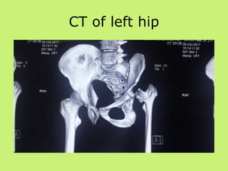 Complex primary hip replacement Dr.A.K.Venkatachalam | PPTX