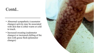 Complex regional | PPT