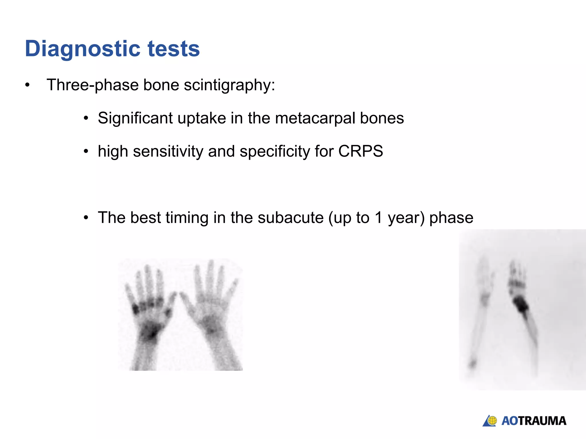 Complex regional pain syndrome | PDF