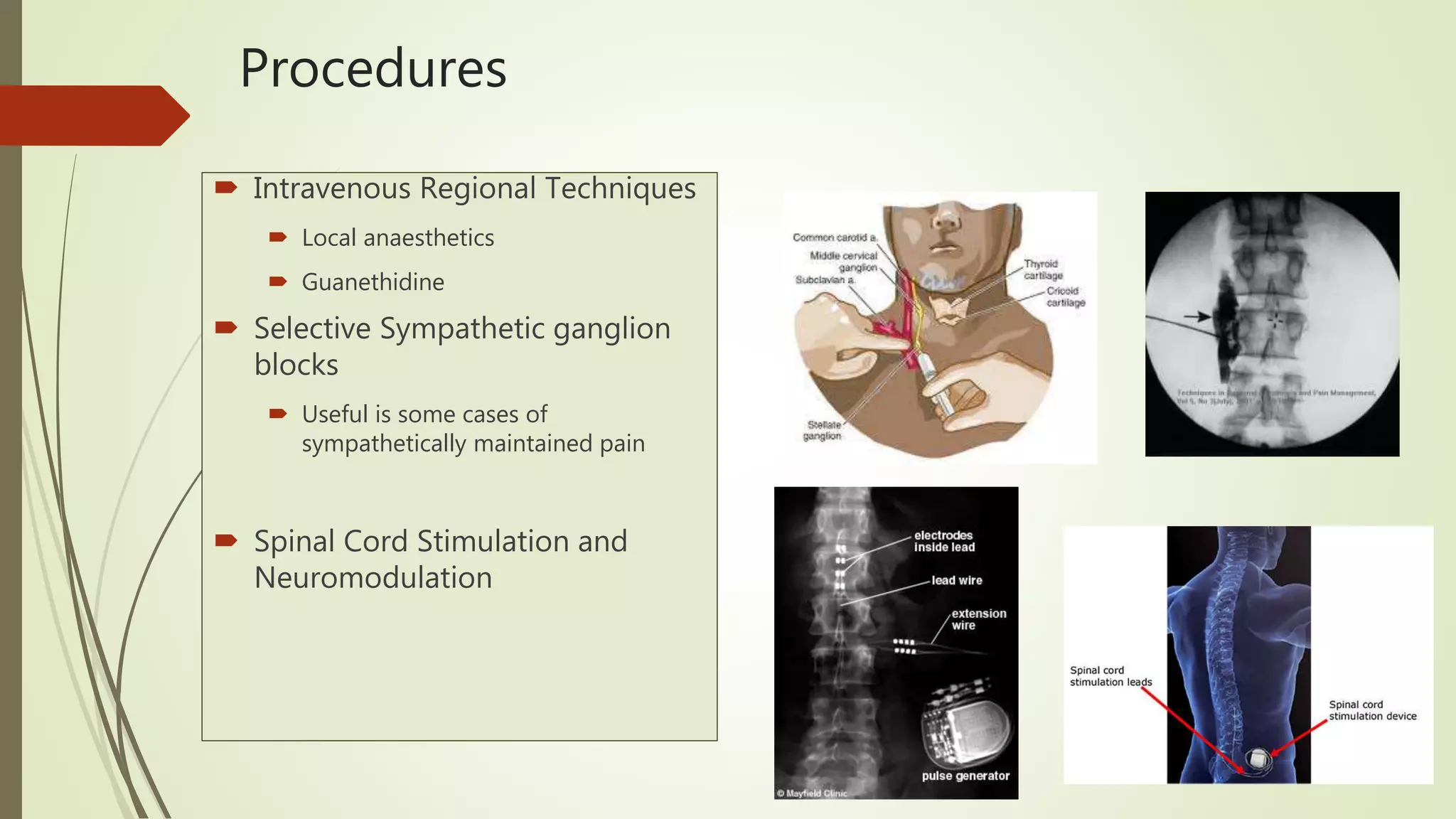 Complex regional pain syndrome | PPTX