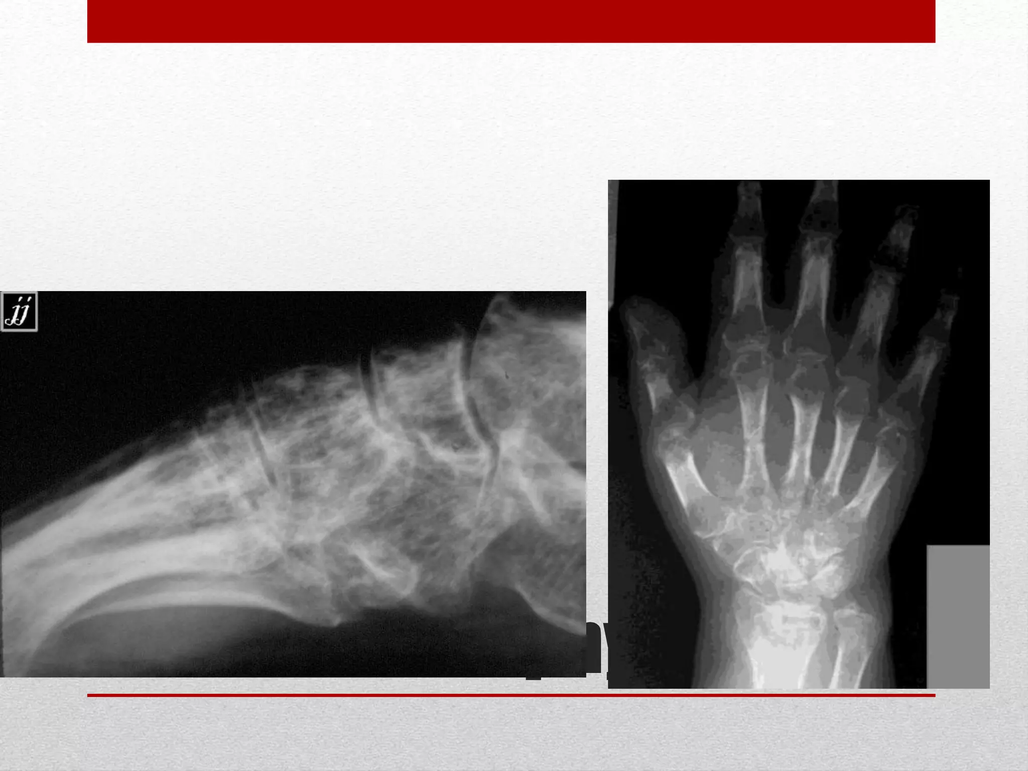 Complex regional pain syndrome Petrus Iitula | PPTX