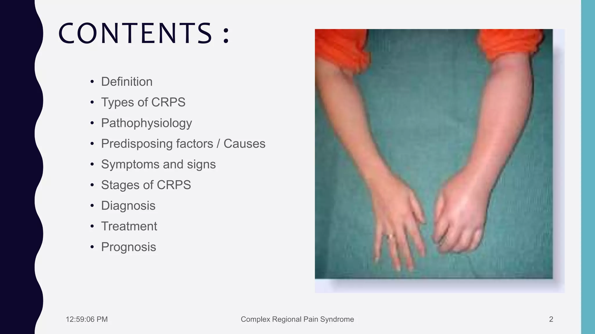 Complex regional pain syndrome | PPTX