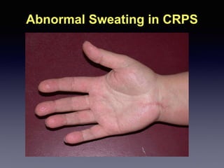 Complex Regional Pain Syndrome | PPTX