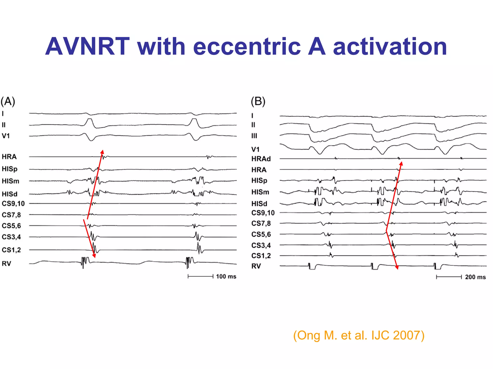 Differentiation between AVNRT and AVRT_advanced lecture | PDF