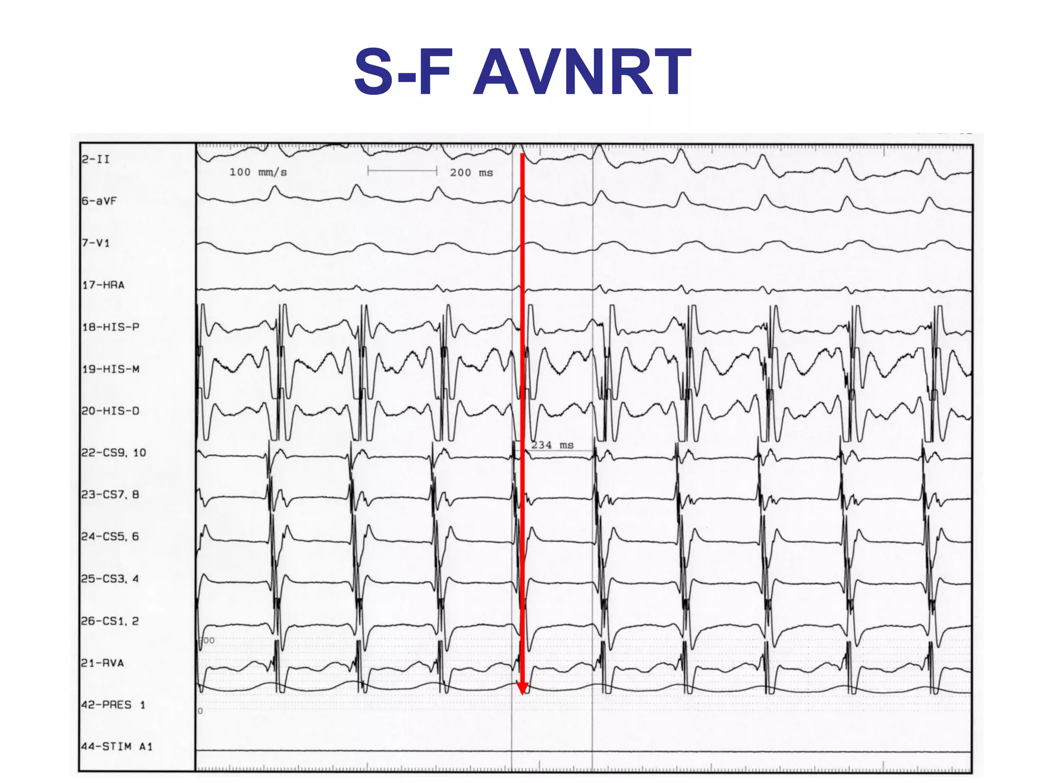Differentiation between AVNRT and AVRT_advanced lecture | PDF