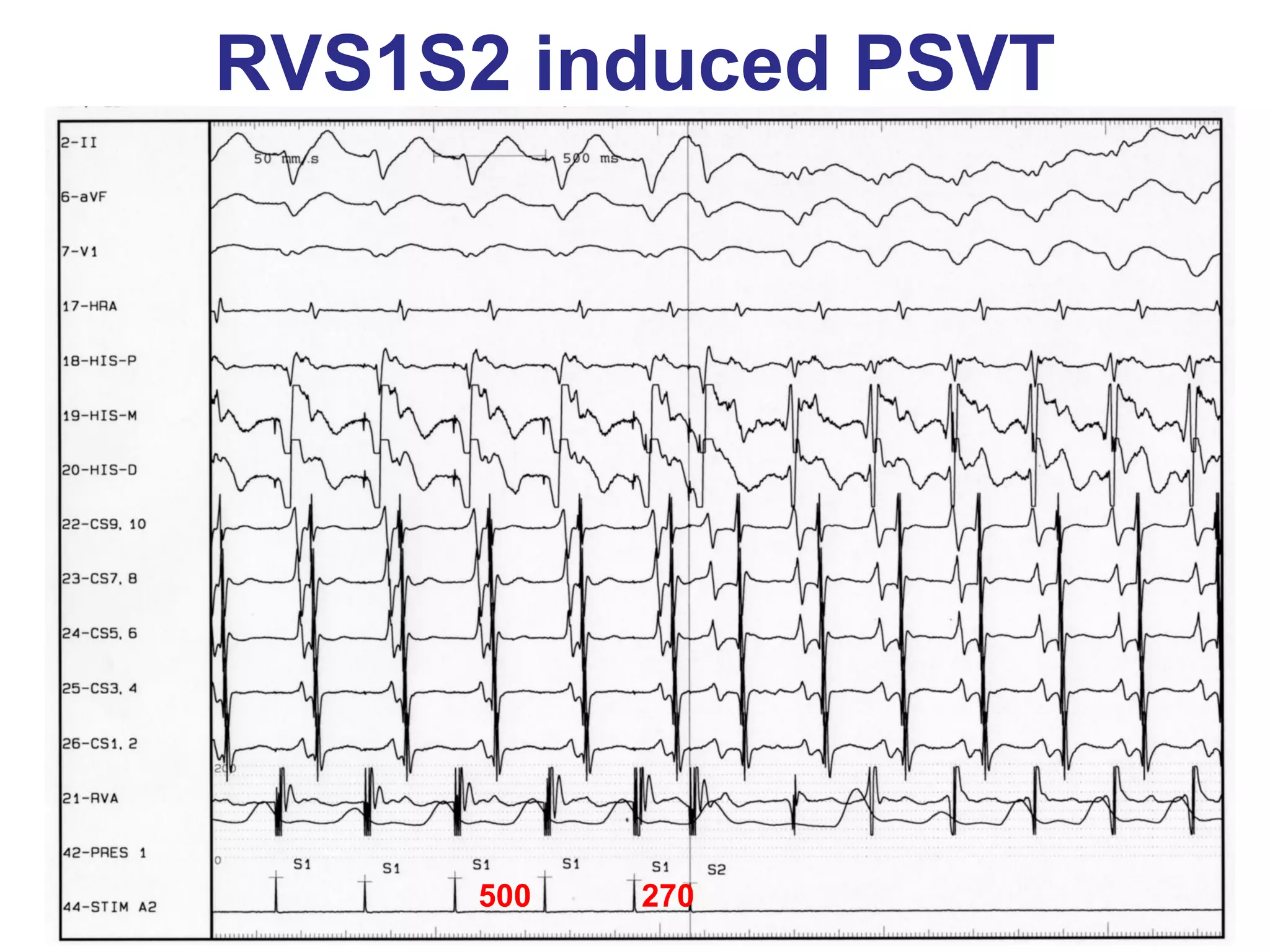 Differentiation between AVNRT and AVRT_advanced lecture | PDF