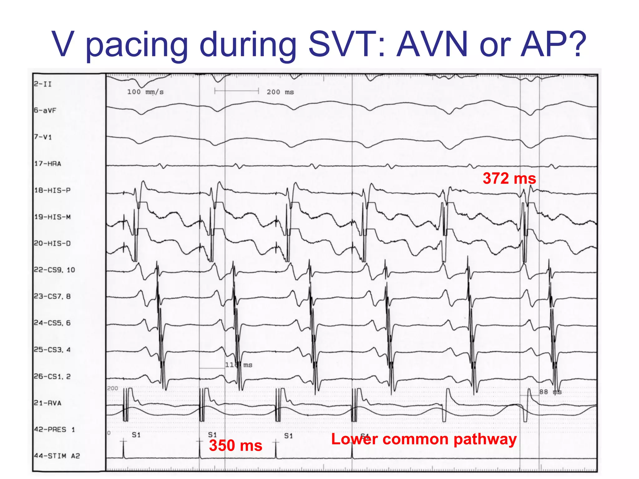 Differentiation between AVNRT and AVRT_advanced lecture | PDF