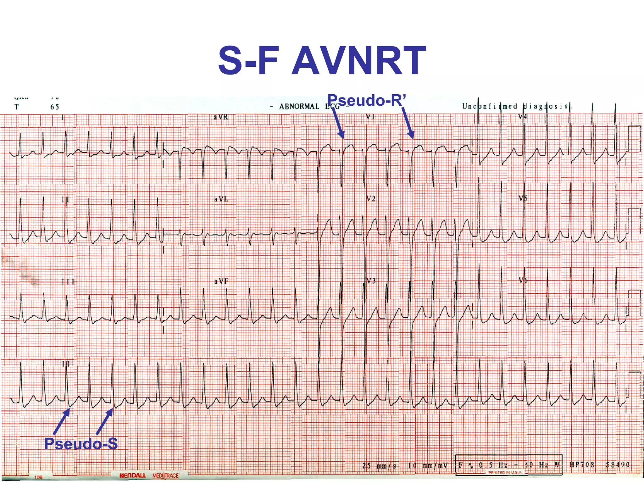 Differentiation between AVNRT and AVRT_advanced lecture | PDF