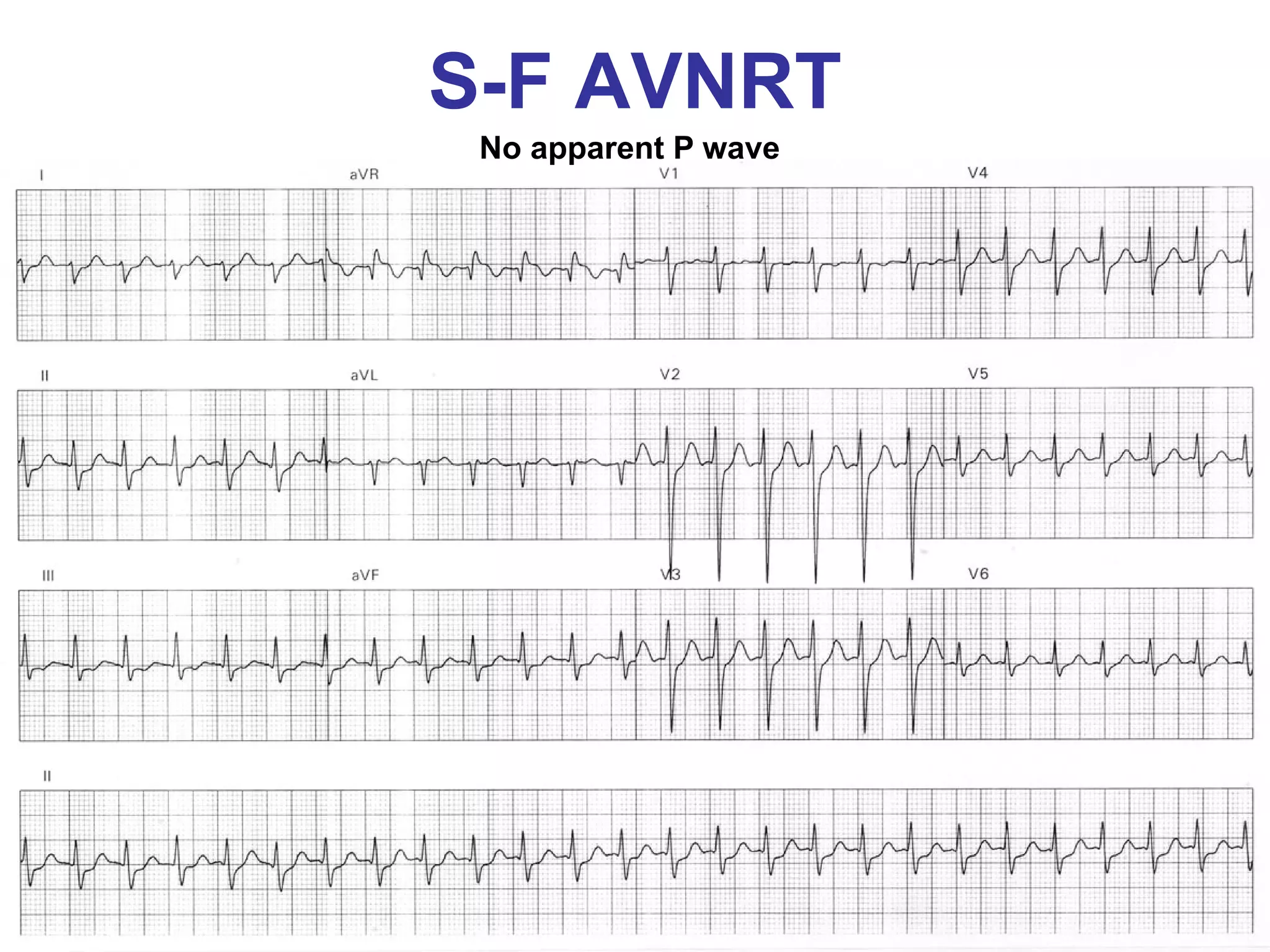 Differentiation between AVNRT and AVRT_advanced lecture | PDF