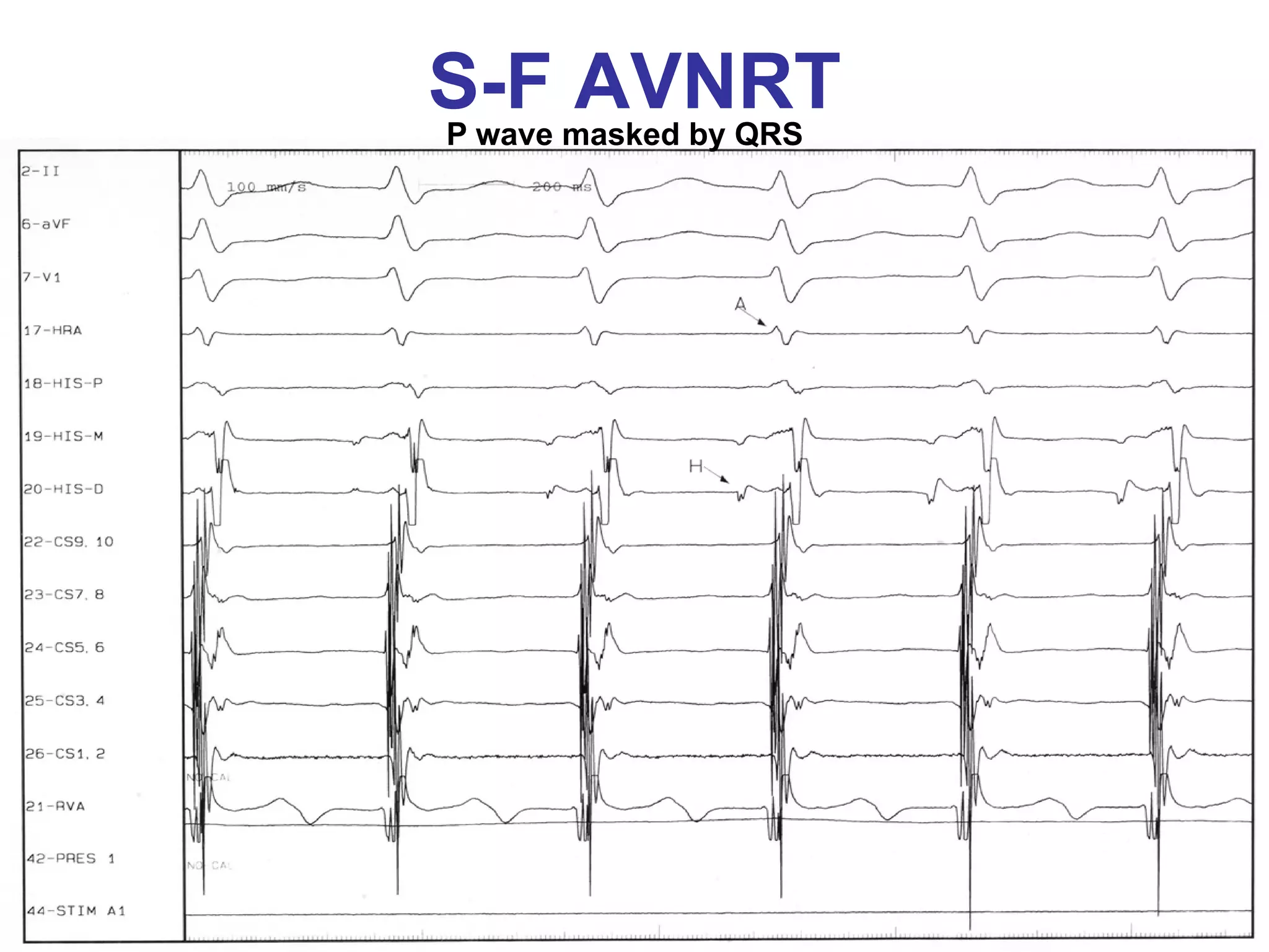 Differentiation between AVNRT and AVRT_advanced lecture | PDF