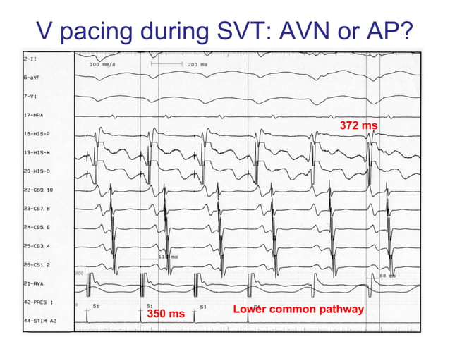 Differentiation between AVNRT and AVRT_advanced lecture | PDF