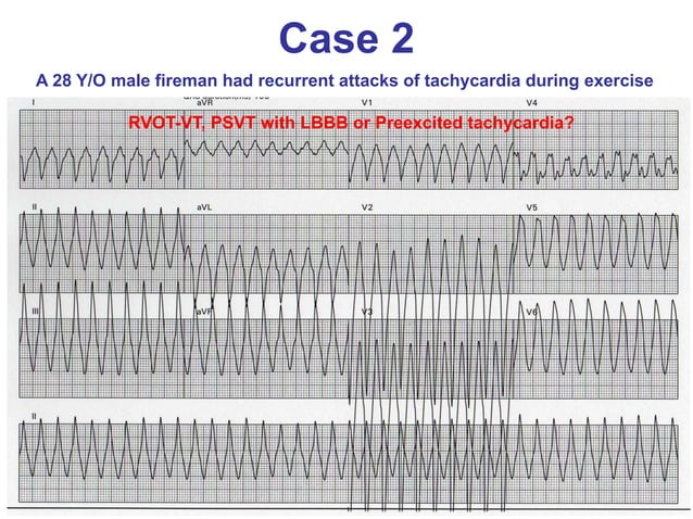 Differentiation between AVNRT and AVRT_advanced lecture | PDF