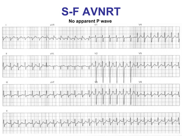 Differentiation between AVNRT and AVRT_advanced lecture | PDF