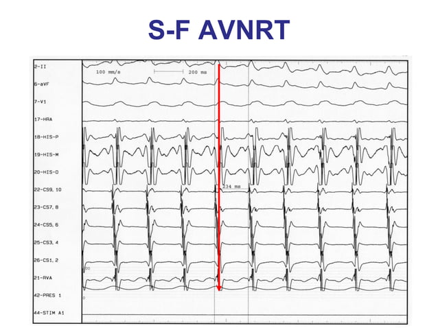 Differentiation between AVNRT and AVRT_advanced lecture
