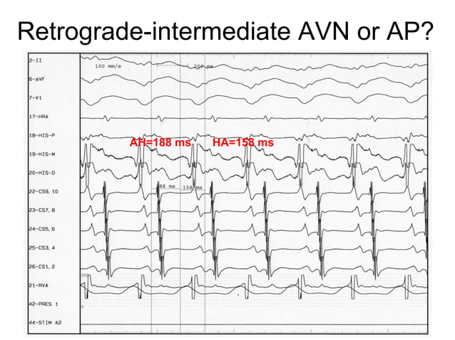 Differentiation between AVNRT and AVRT_advanced lecture