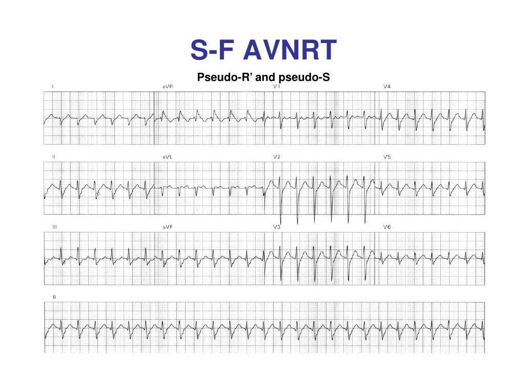 Differentiation between AVNRT and AVRT_advanced lecture