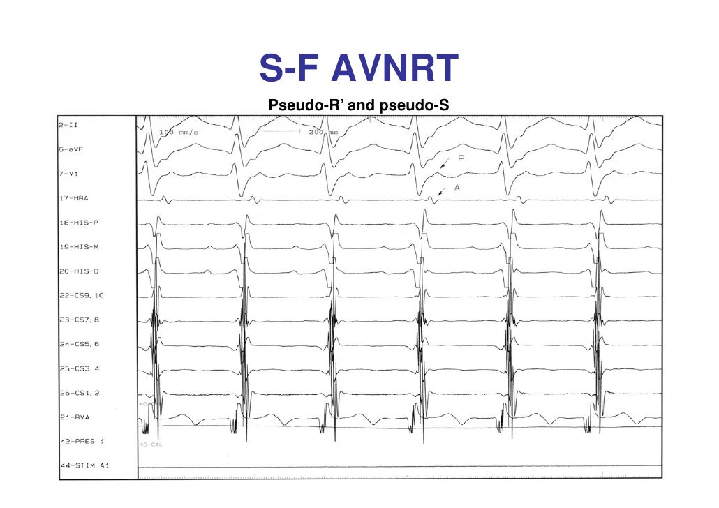 Differentiation between AVNRT and AVRT_advanced lecture