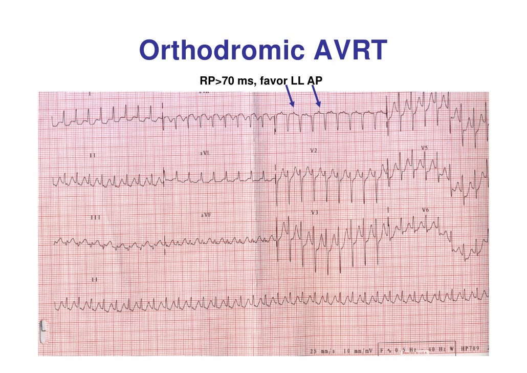Differentiation between AVNRT and AVRT_advanced lecture
