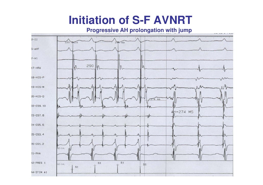 Differentiation between AVNRT and AVRT_advanced lecture