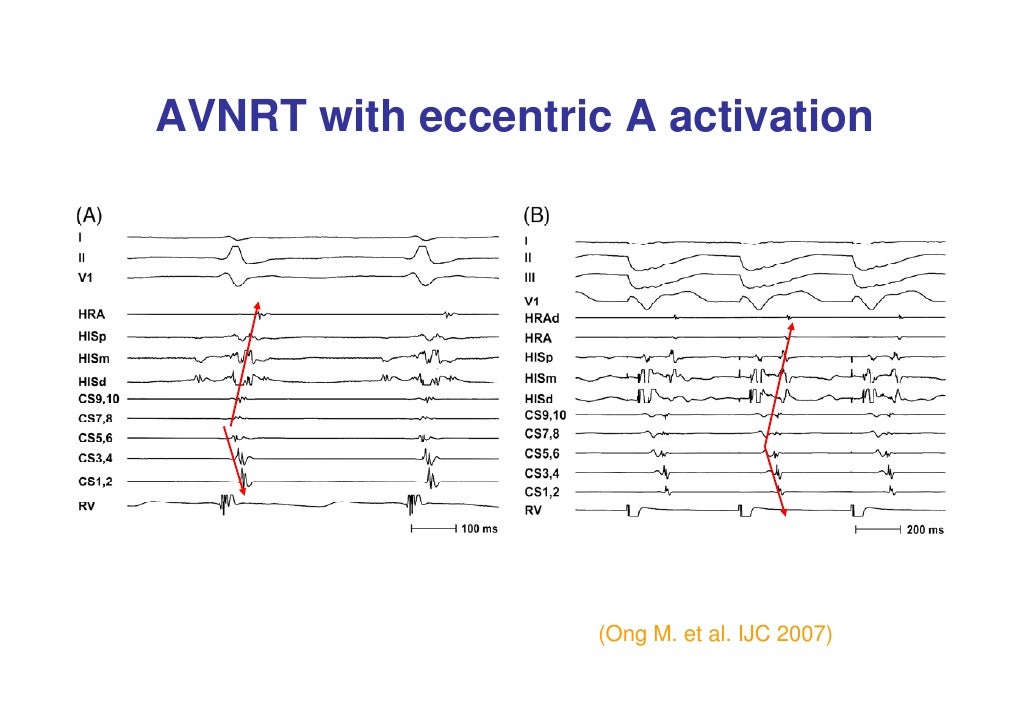 Differentiation between AVNRT and AVRT_advanced lecture
