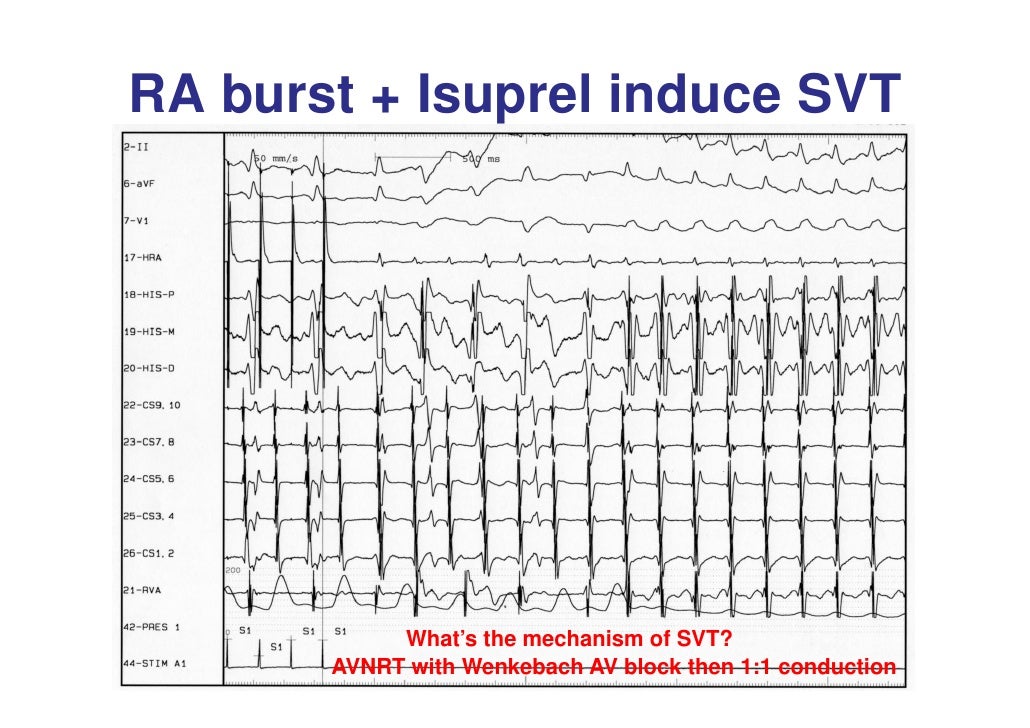 Differentiation between AVNRT and AVRT_advanced lecture