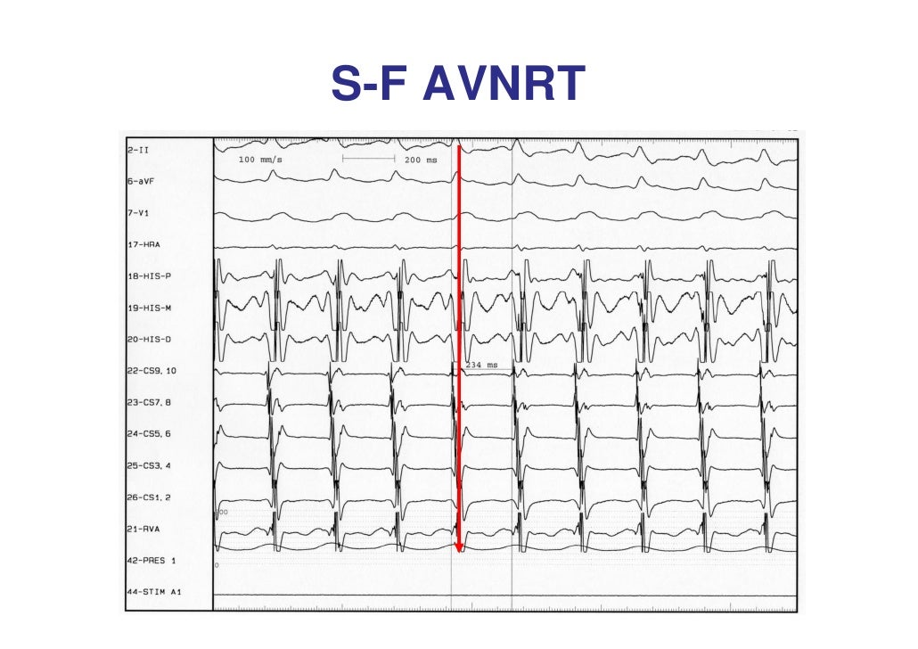 Differentiation between AVNRT and AVRT_advanced lecture