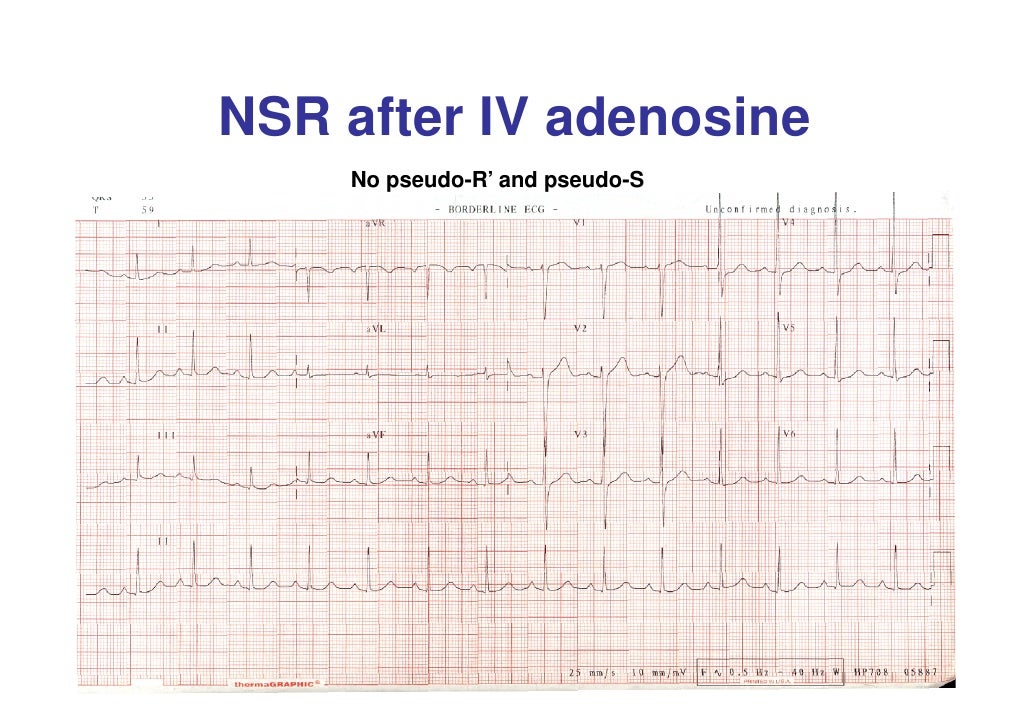 Differentiation between AVNRT and AVRT_advanced lecture