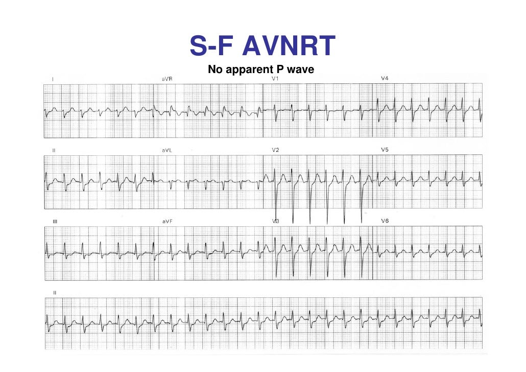 Differentiation between AVNRT and AVRT_advanced lecture