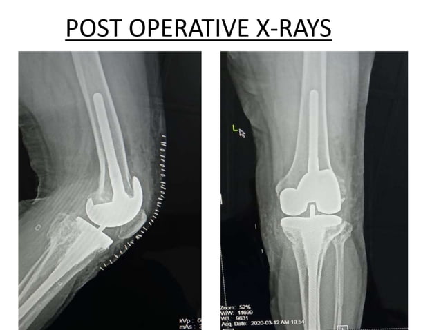Complex TOTAL KNEE ARTHROPLASTY | PPT
