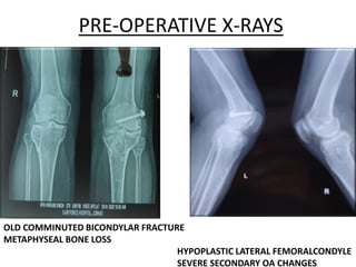 Complex TOTAL KNEE ARTHROPLASTY | PPT