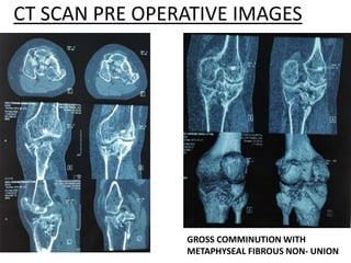 Complex TOTAL KNEE ARTHROPLASTY | PPT