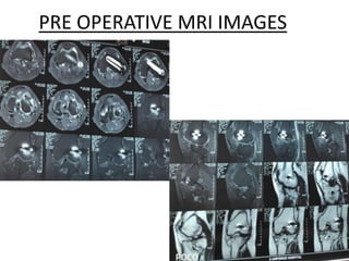 Complex TOTAL KNEE ARTHROPLASTY | PPT