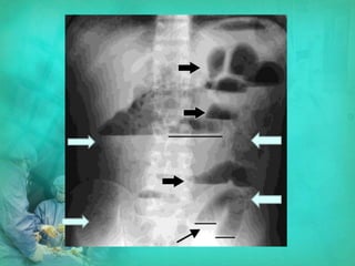 Complications GI surgery | PPT | Digestive Disorders | Diseases and ...