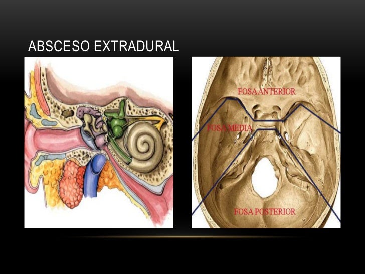 Complicaciones de la otitis media