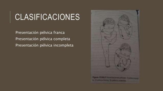 Complicaciones del parto | PPTX | Pregnancy | Reproductive Health