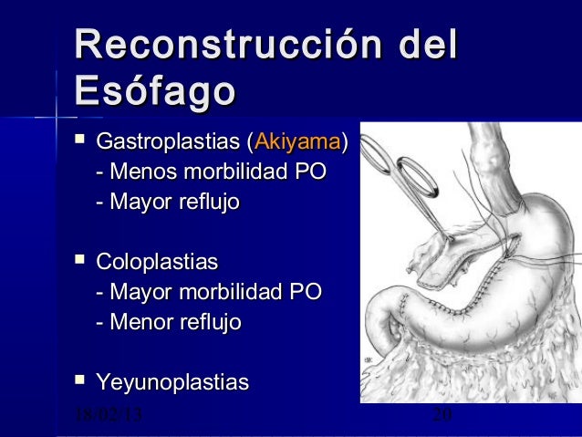 Complicaciones post operatorias de la esofaguectomía, DR JUAN SANGUIN…